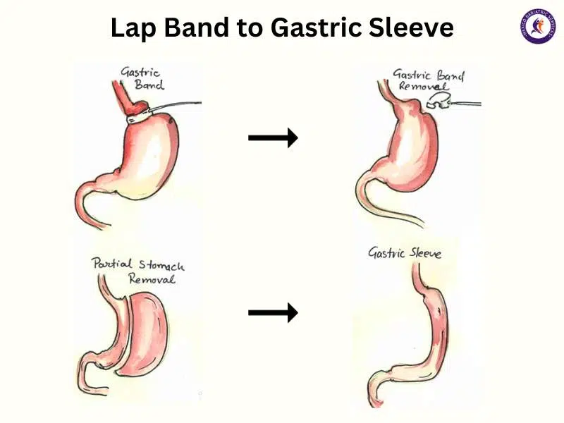 Affordable Lap Band to Gastric Sleeve Revision in Tijuana | Save ~70%